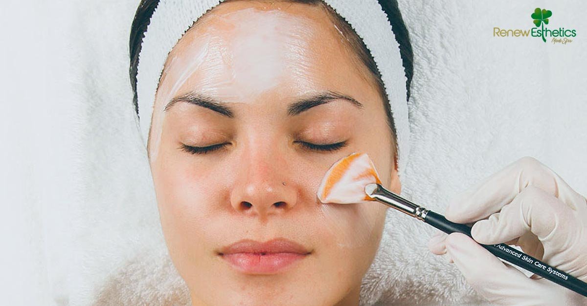 All About Peeling | Renew Esthetics | Astoria NY