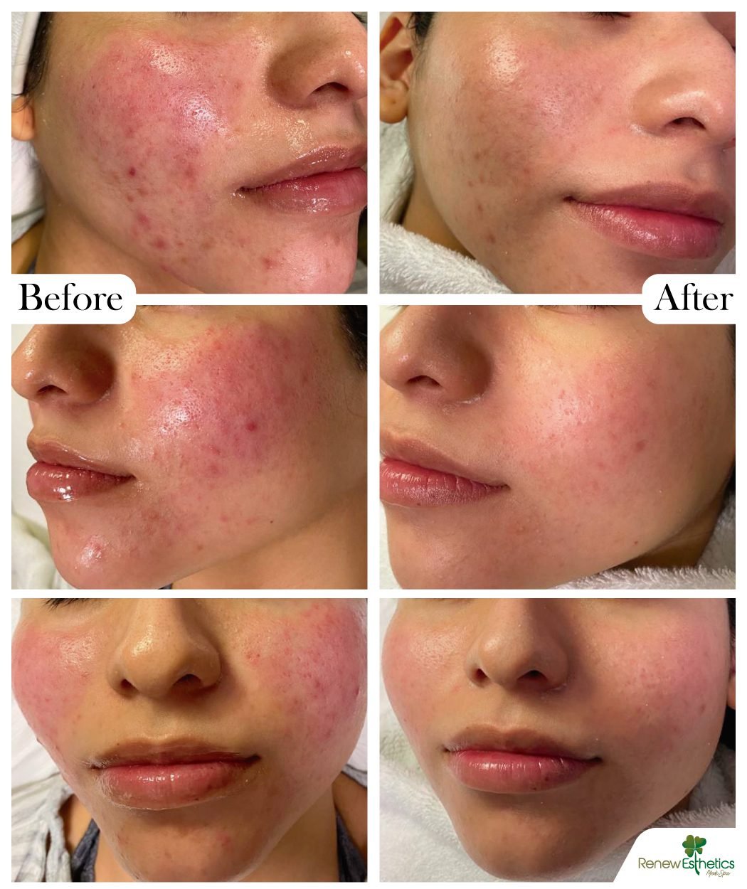 Acne Treatment in Astoria NY | Renew Esthetics MediSpa