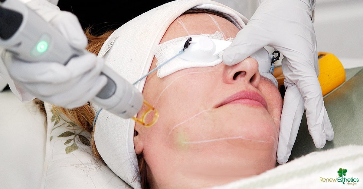 Amazing Skin Rejuvenation with Laser with #1 MediSpa in NY